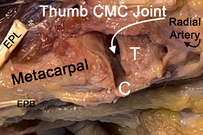 Thumb CMC (Basilar) Joint Anatomy | Anatomic Structures at Risk